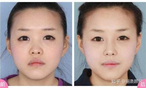 玻尿酸隆鼻效果图 知乎