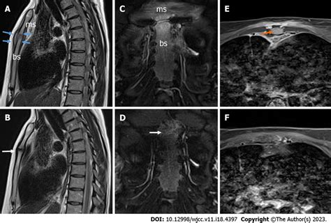 Magnetic Resonance Imaging Of The Septic Manubriosternal Joint A Download Scientific Diagram