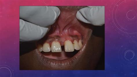 Peripheral Ossifying Fibroma Pptx Dental Health Diseases And Conditions