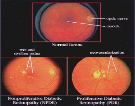 Figure 11 From Microaneurysms Detection In Fundus Retinal Images Using