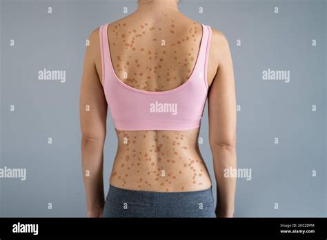 Woman Body Skin Rash With Red Allergy Eruption Stock Photo Alamy