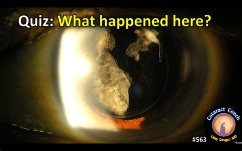 Quiz Retained Cortex 563 Title Cataract Coach™