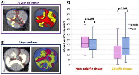 Sex Specific Differences In Aortic Valve Composition Quantified From