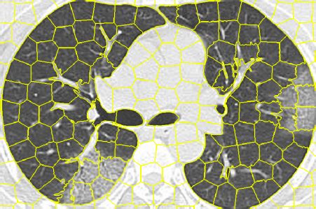 CT Scan Slice Segmented Into Superpixels Download Scientific Diagram