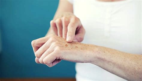 Как осветлить возрастные пигментные пятна на руках 2 простых рецепта из подручных компонентов