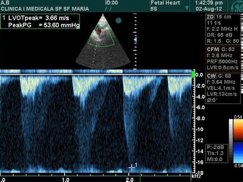 Patient D R M Echocardiography Suprasternal View Severe Download Scientific Diagram