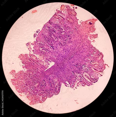 Sigmoid Colon Colonoscopic Biopsy Chronic Nonspecific Colitis Show Colonic Mucosa Chronic