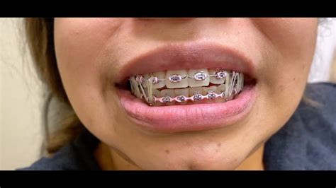 Rubber Bands For Braces Artofit