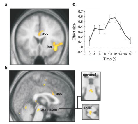 Temporal Difference Value Statistical Parametric Maps And Impulse Download Scientific Diagram
