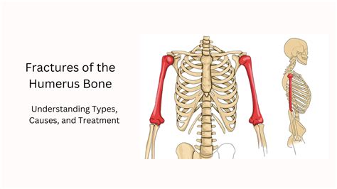 Fractures Of The Humerus Bone Understanding Types Causes And Treatment