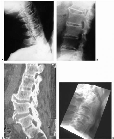 Skeletal And Extraskeletal Calcification And Ossification Syndromes