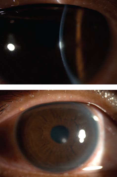 Infiltrative Keratitis