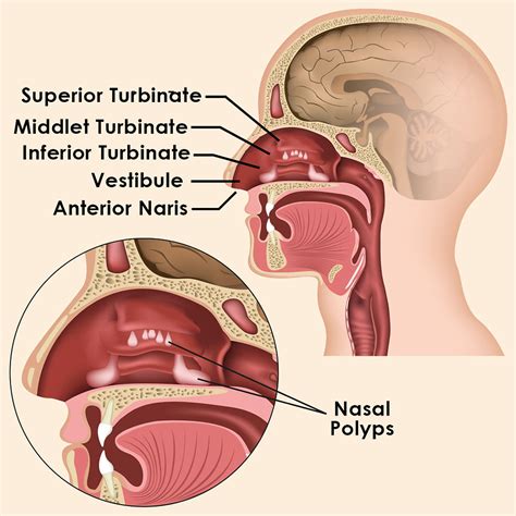 Nasal Polyps Symptoms Causes Treatment And Prevention