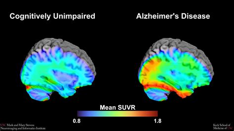 Early Alzheimers Detection Brain Scan Breakthrough Archyde