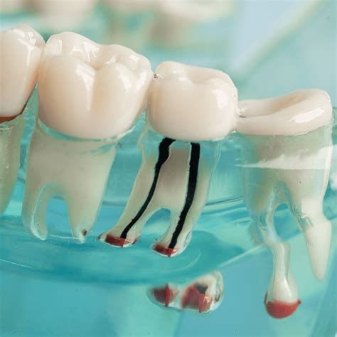 Why Wisdom Teeth Removal Is Essential For Oral Health Dental Implant