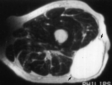 Liposarcoma Radiopaedia Liposarcoma Radiopaedia