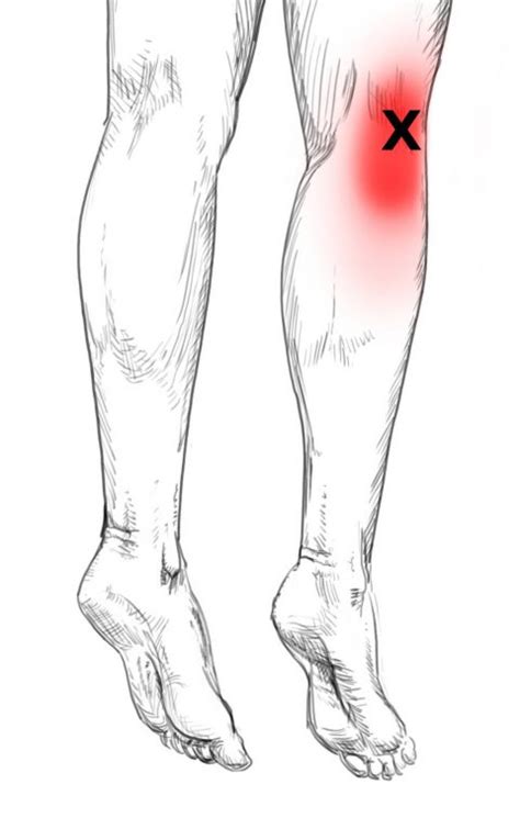Upper Calf Tendonitis