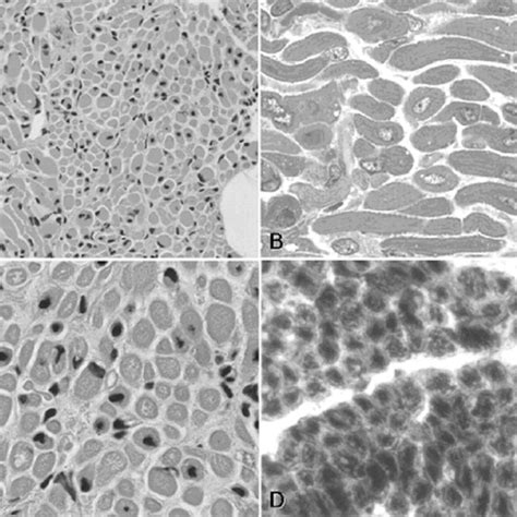 Pdf X Linked Myotubular Myopathy Report Of A Case With Novel Mutation