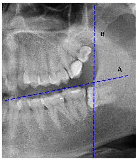 The Pattern Of Mandibular Third Molar Impaction And Assessment Of