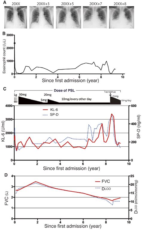 Figure1 The 9 Year Clinical Course Of Eosinophilic Pneumonia Preceding