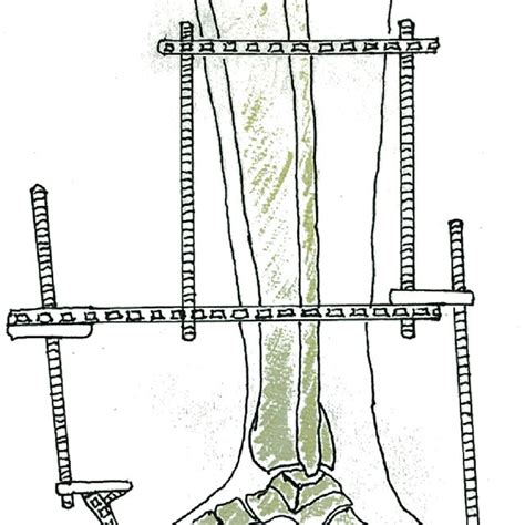 A Schematic Illustration Of The Ilizarov Device Four Rings Two Tibial