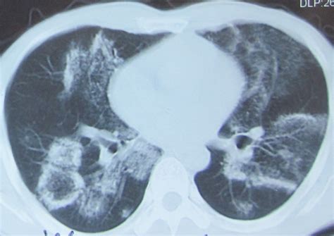 肺结核如何诊断从胸部 CT 到实验室检查一文讲清 世界防治结核病日 财经头条