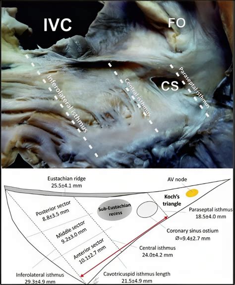 Cavotricuspid Isthmus Dependent Atrial Flutter Beyond Simple Linear