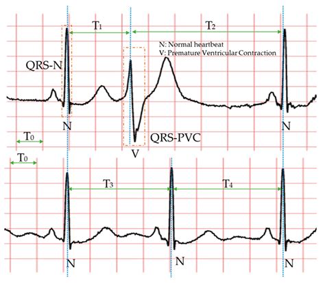 Premature Ventricular Contraction