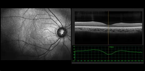 Crstoday Macular Oct Imaging Before Cataract Surgery