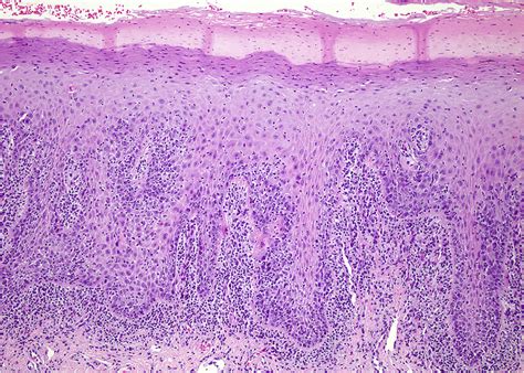 Figure 19 From The Lichenoid Tissue Reactions Of The Oral Mucosa Oral