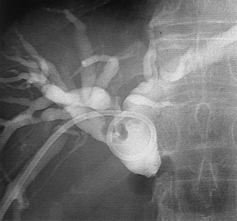 Cholangiocarcinoma Pictorial Essay Of Ct And Cholangiographic Findings