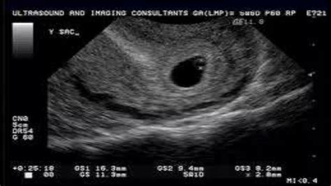 Assessment Gestational Age Pptx