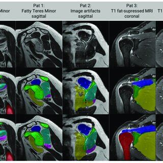 Examples Of Insufficiently Accurate Segmentations On The T Weighted
