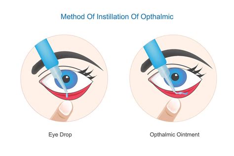 Method Of Instillation Of Opthalmic Correct Use Of Eye Drops And