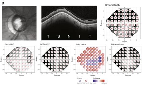 Computational Ophthalmology Big Data Machine Learning Data Science