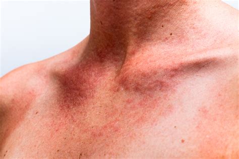 What Can Cause Rash On Neck And Chest Medicinenet 2021
