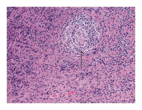 Histopathology Of The Resected Small Bowel Lesion A Hande Stain