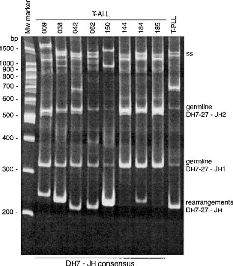 Figure 2 From Ig Heavy Chain Gene Rearrangements In T Cell Acute Lymphoblastic Leukemia Exhibit