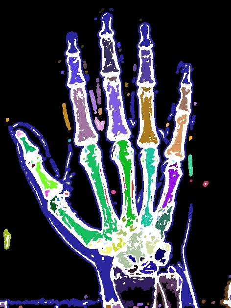 Php Fracture Detection In Hand Using Image Proccessing Stack Overflow