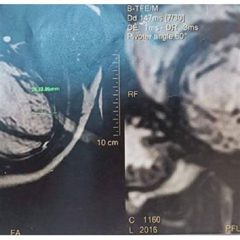 Cardiac Magnetic Resonance Imaging Showing Non Compacted Trabeculation Download Scientific