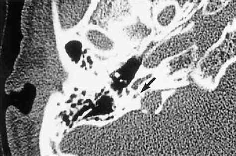 Figure 1 From Scala Vestibuli Insertion In Cochlear Implantation A Valuable Alternative For
