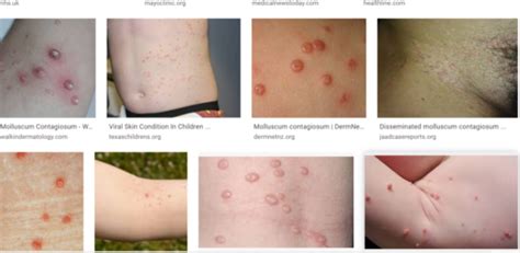 Viral Skin Infections Flashcards Quizlet