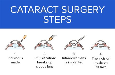 Will My Nearsightedness Get Better After Cataract Surgery Eye