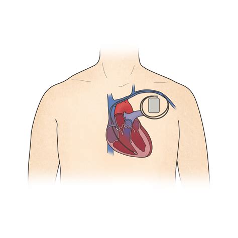 제세동기삽입술 시술수술안내 일반인정보 심장병원 서울아산병원