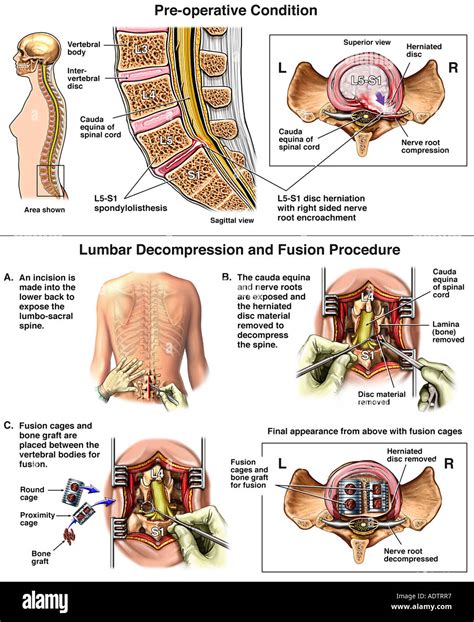 Back Nerve Decompression Surgery At Alan Matheny Blog