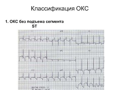 Острый коронарный синдром ОКС