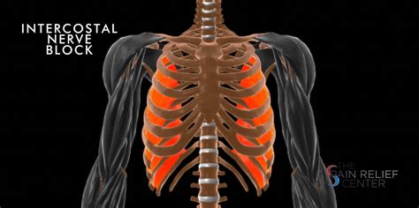 Intercostal Nerve Block