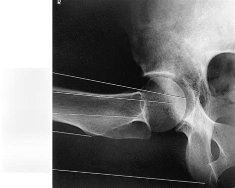 Xr Hip Lateral Diagram Quizlet