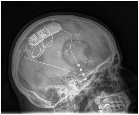 Critical Review Of The Responsive Neurostimulator System For Epilepsy Mder