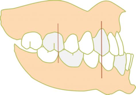 Classification Of Occlusion